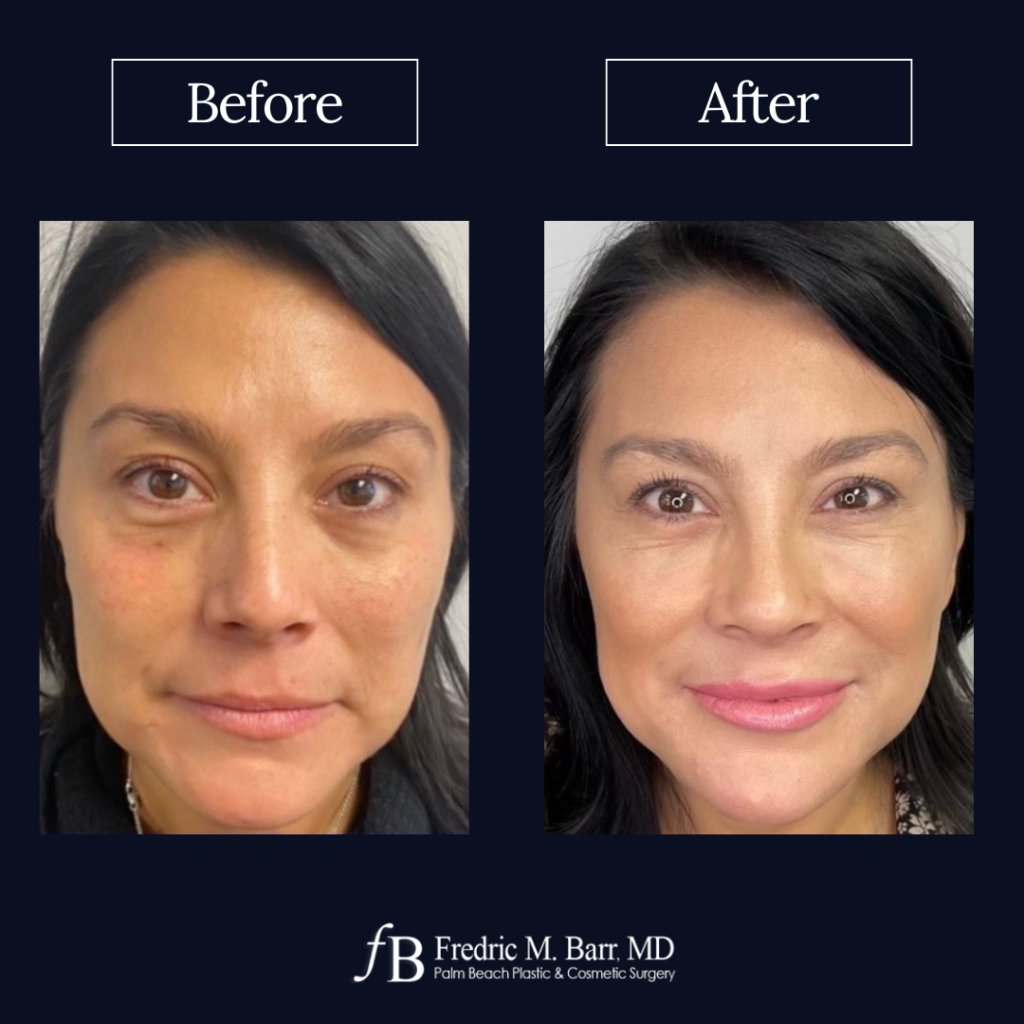 Dermal Filler Gallery | Palm Beach Plastic & Cosmetic Surgery