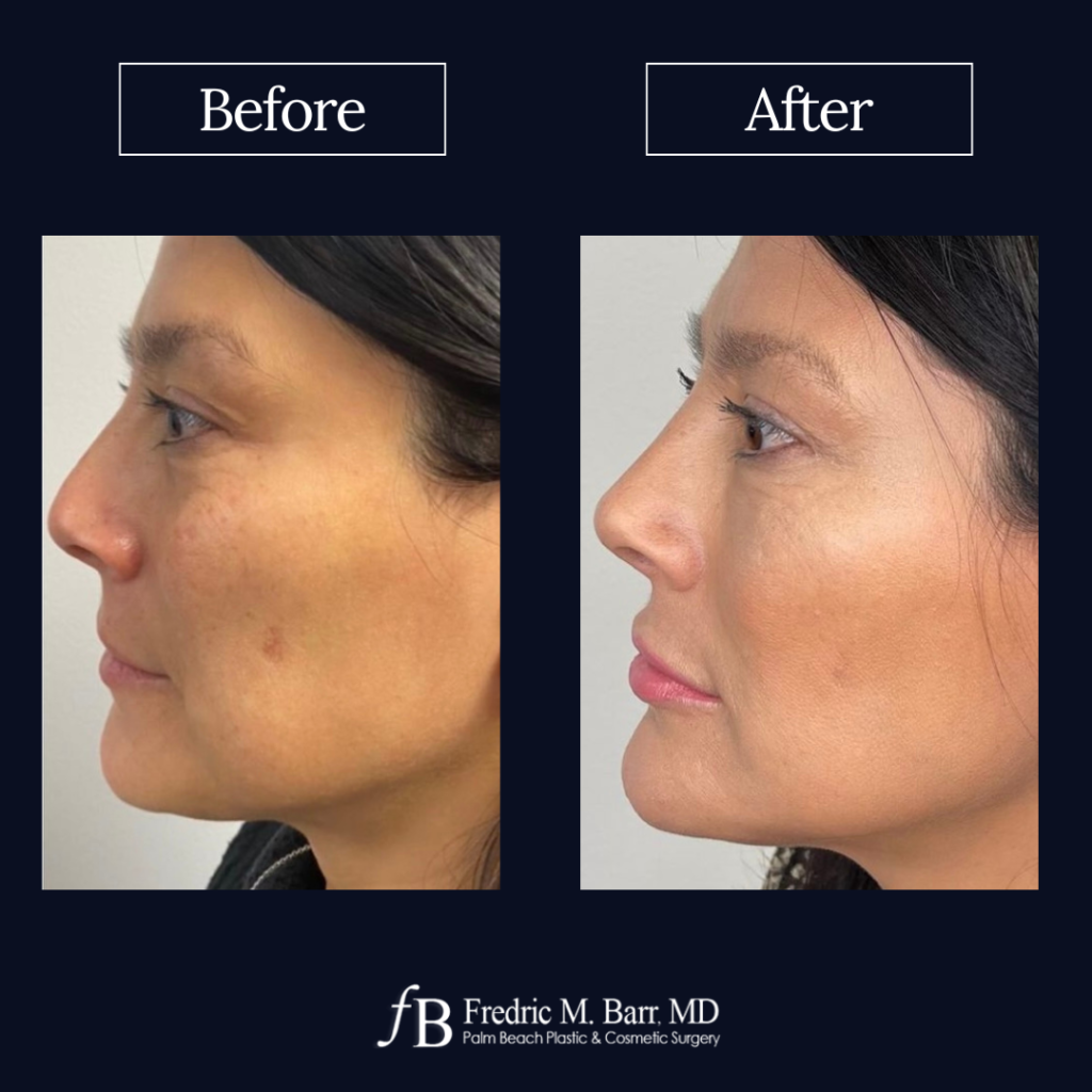 Dermal Filler Gallery | Palm Beach Plastic & Cosmetic Surgery