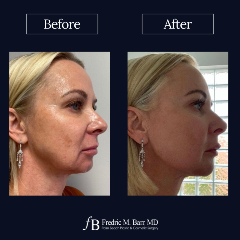Dermal Filler Gallery | Palm Beach Plastic & Cosmetic Surgery