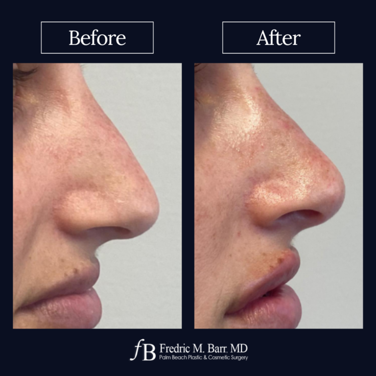 Dermal Filler Gallery | Palm Beach Plastic & Cosmetic Surgery