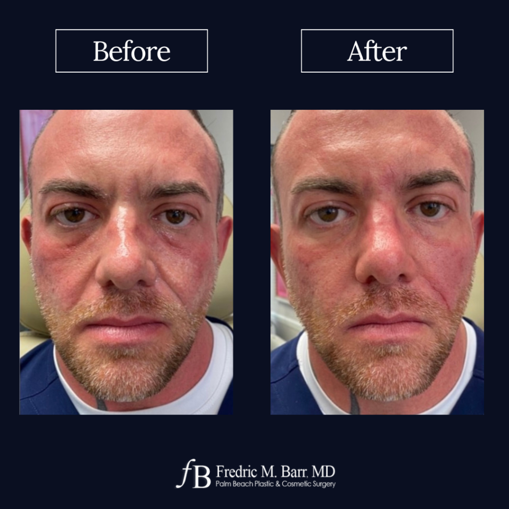 Dermal Filler Gallery | Palm Beach Plastic & Cosmetic Surgery