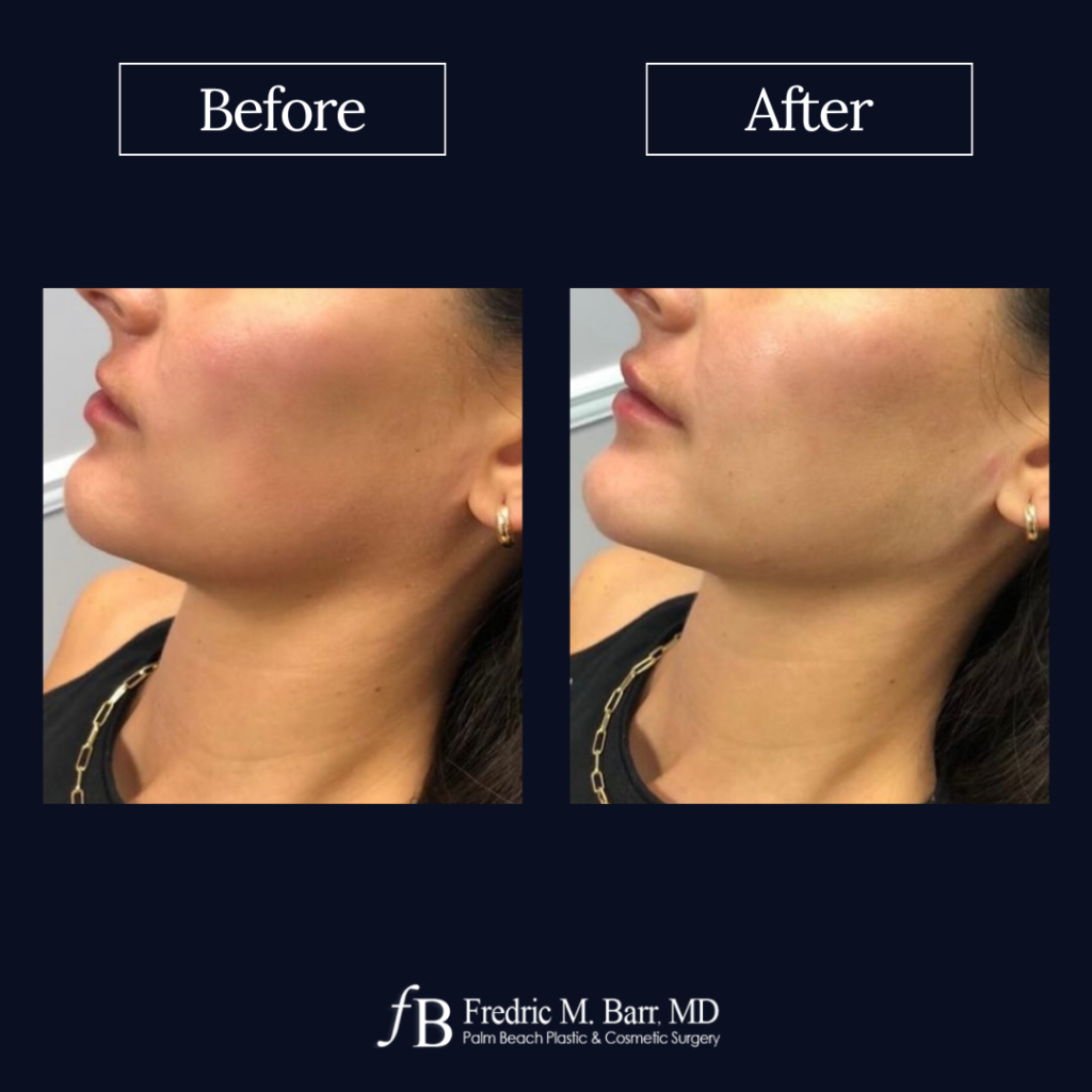 Dermal Filler Gallery | Palm Beach Plastic & Cosmetic Surgery