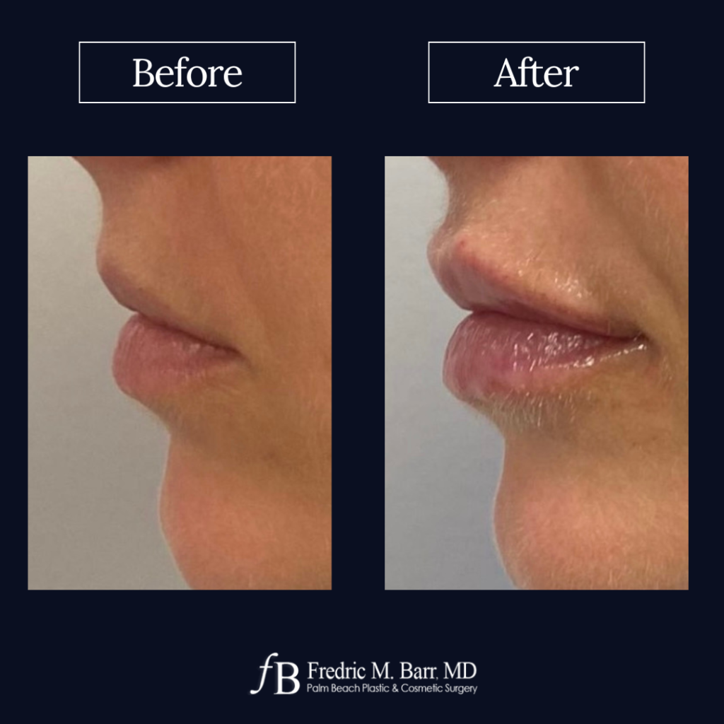Dermal Filler Gallery | Palm Beach Plastic & Cosmetic Surgery
