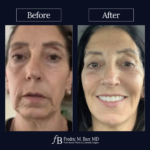 Mini Face/Awake Lift Gallery in Palm Beach Plastic & Cosmetic Surgery