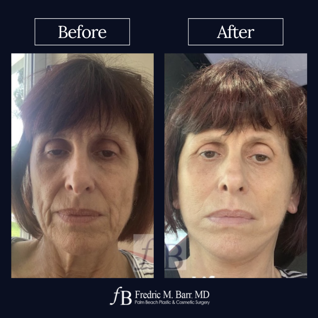 Mini Face/Awake Lift Gallery in Palm Beach Plastic & Cosmetic Surgery