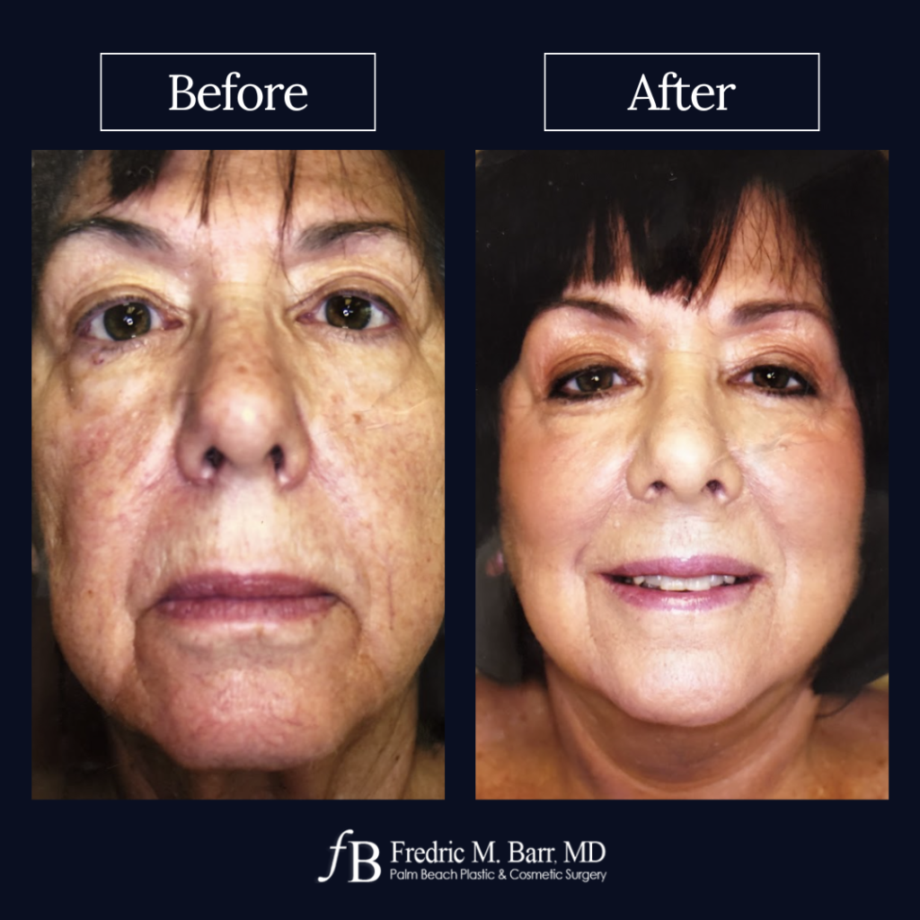 Mini Face/Awake Lift Gallery in Palm Beach Plastic & Cosmetic Surgery