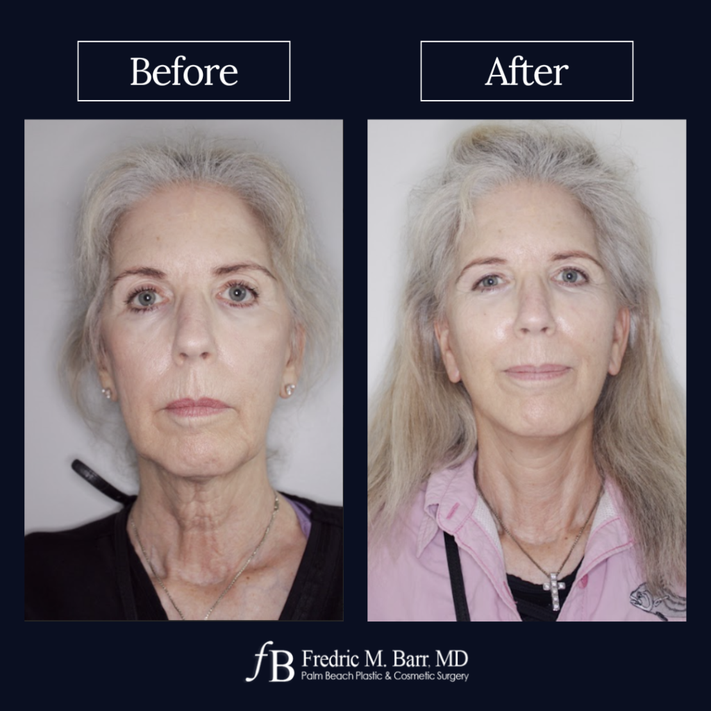Mini Face/Awake Lift Gallery in Palm Beach Plastic & Cosmetic Surgery