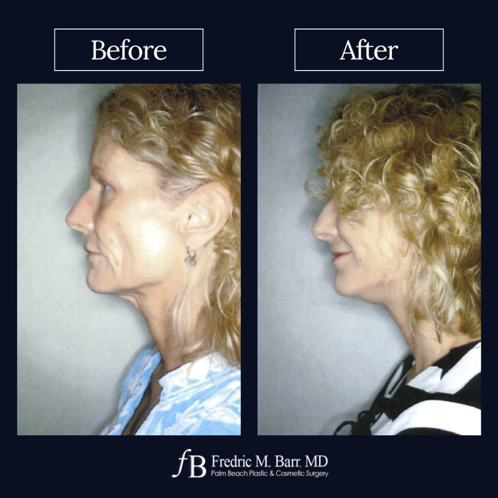 Mini Face/Awake Lift Gallery in Palm Beach Plastic & Cosmetic Surgery
